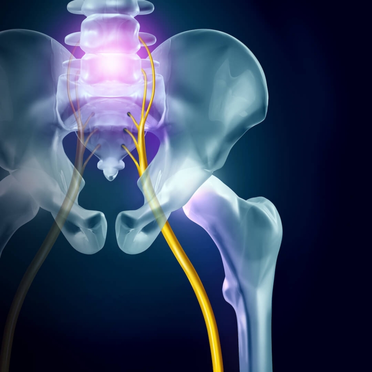 Nerve Pain With Sciatica: What It Is and How We Approach Sciatic ...
