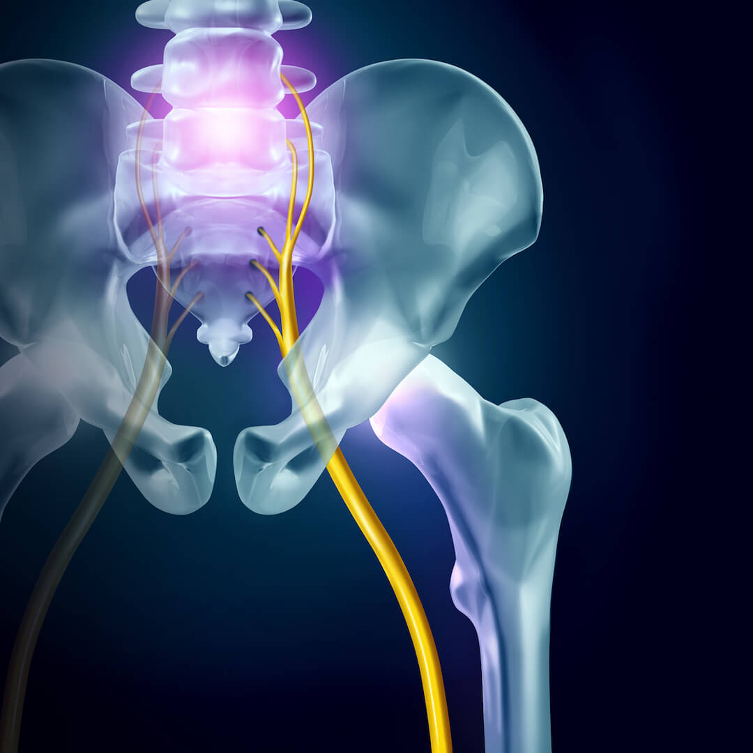 Nerve Pain With Sciatica: What It Is and How We Approach Sciatic ...